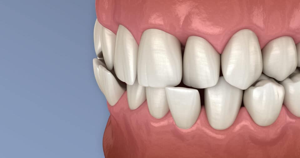 Crossbite Treatment in Phoenix, AZ | Phoenix Orthodontist