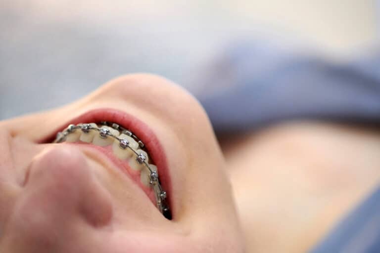 Metal Braces in Phoenix, Arizona | Phoenix Orthodontist