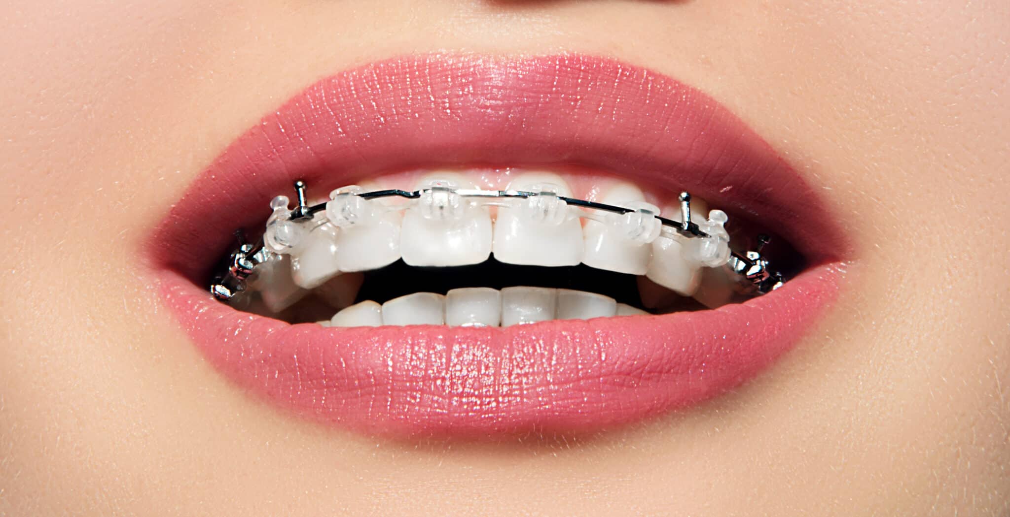 Clear Braces in Phoenix, Arizona | Phoenix Orthodontist