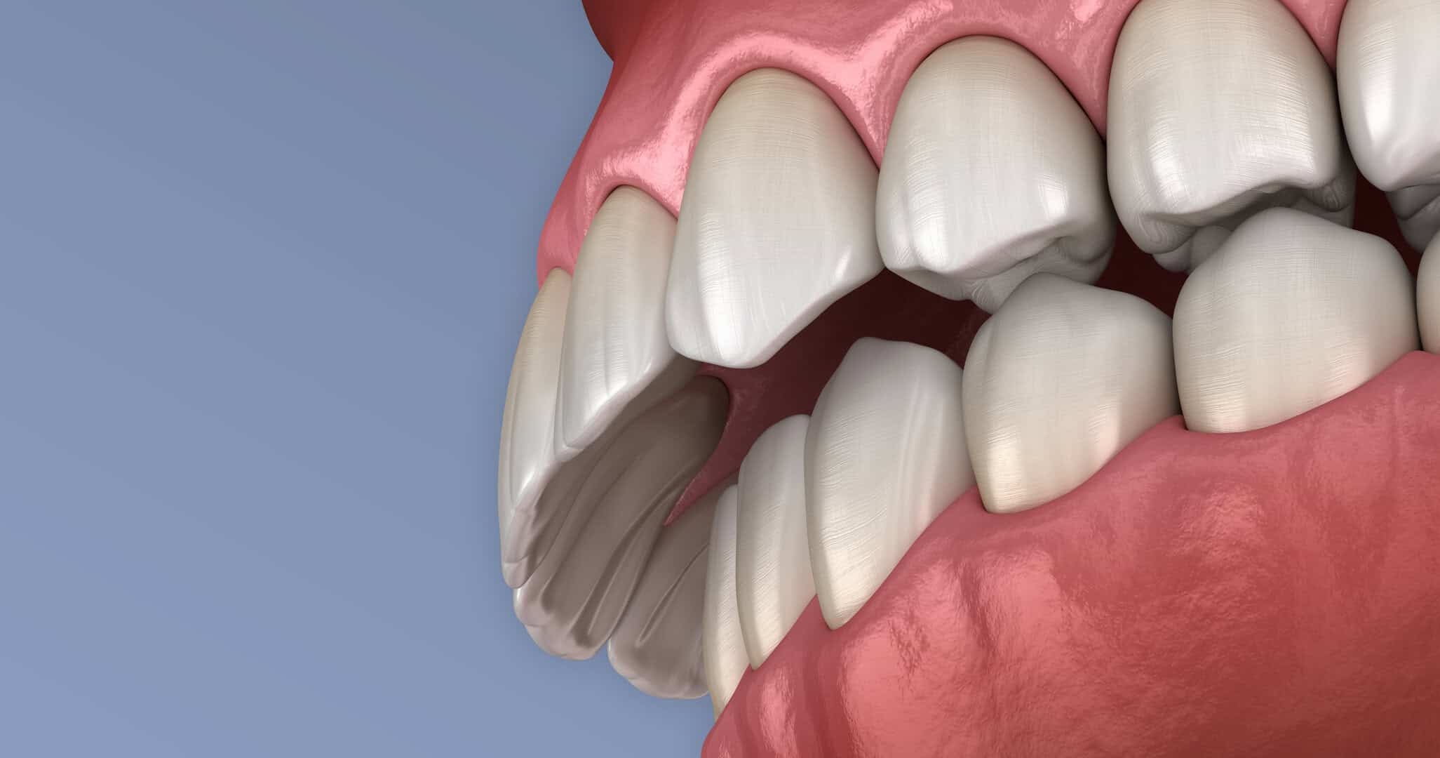 Overbite Treatment in Phoenix, AZ | Phoenix Orthodontist