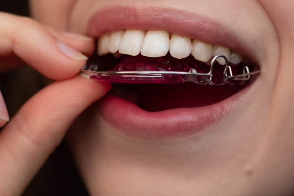 Removable Retainers in Phoenix | Phoenix Orthodontist